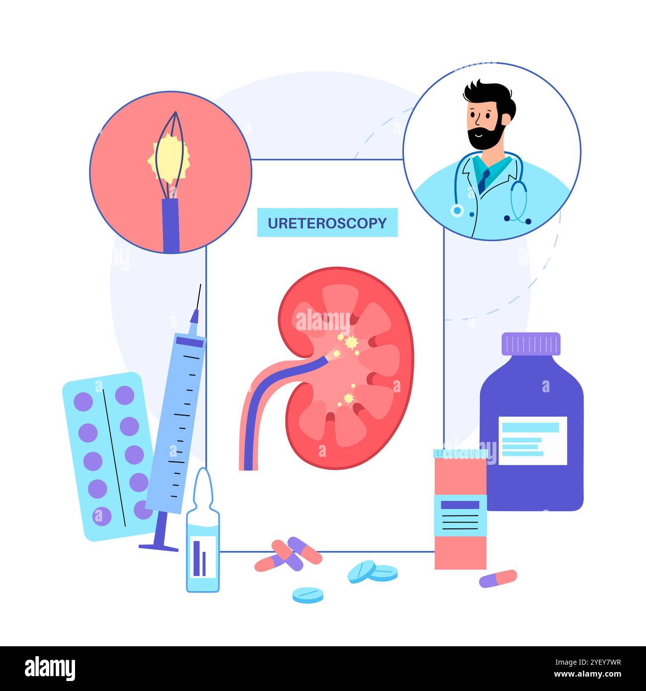 Conceptual illustration of a ureteroscopy procedure. This is a ...