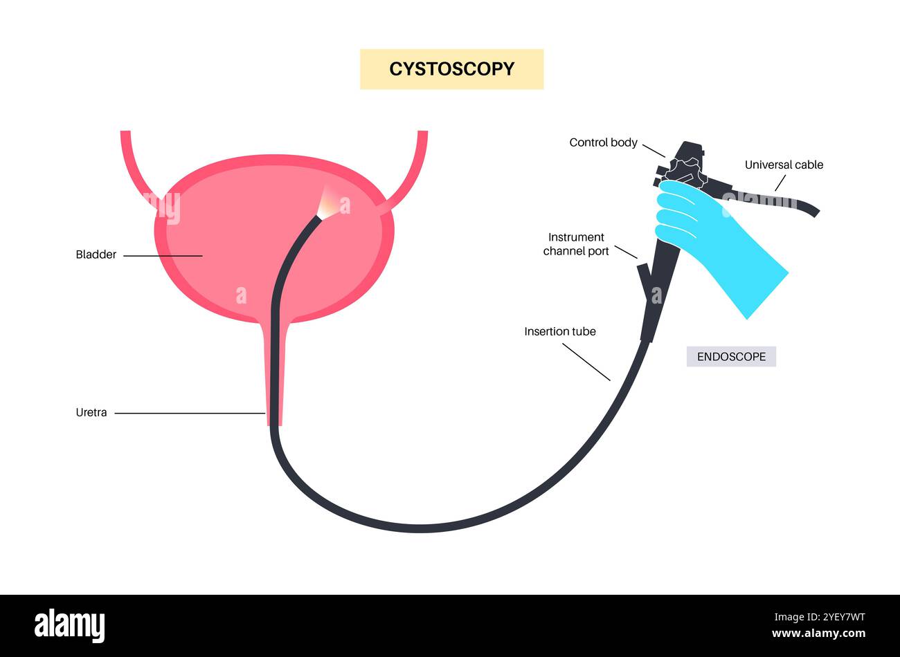 Conceptual illustration of a cystoscopy procedure. This is a procedure used to diagnose, monitor ...