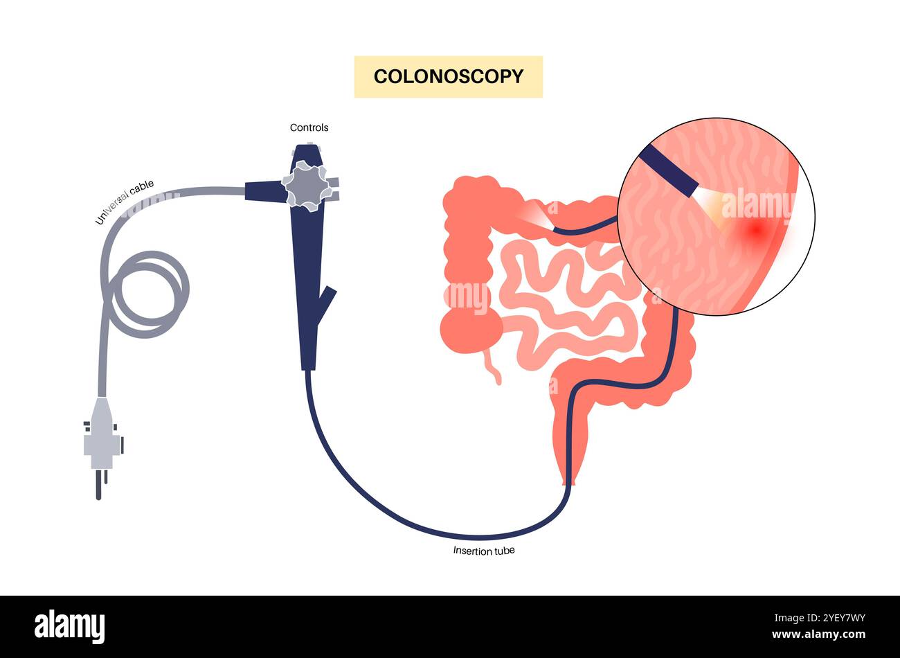 Conceptual illustration of a colonoscopy procedure. This is an ...