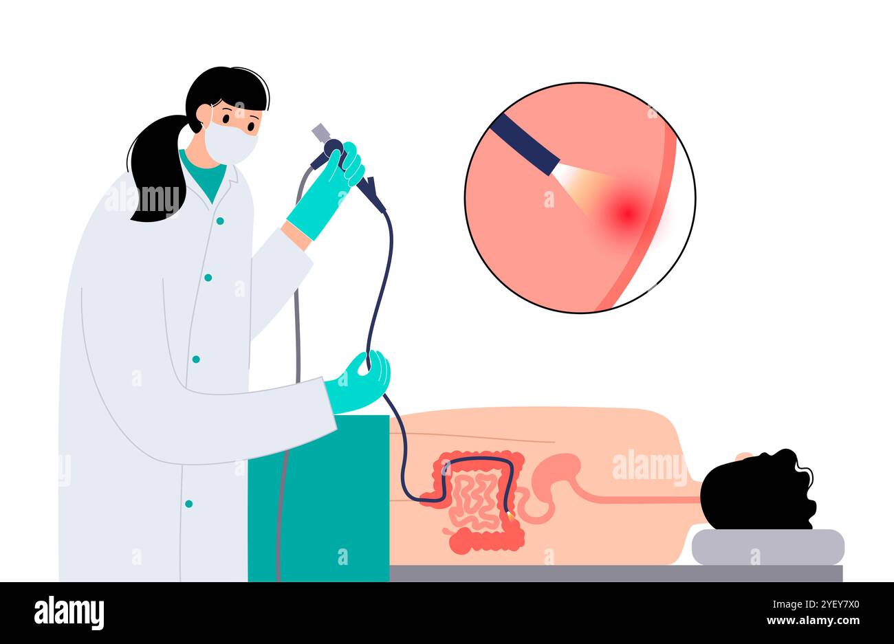 Conceptual illustration of a colonoscopy procedure. This is an ...