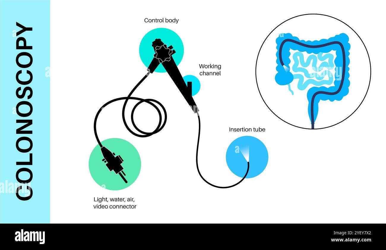 Conceptual illustration of a colonoscopy procedure. This is an ...