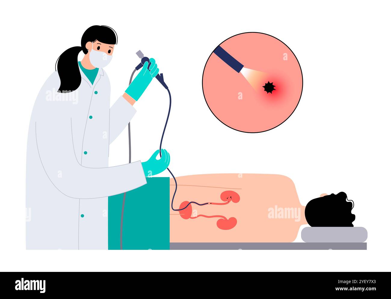 Conceptual illustration of a ureteroscopy procedure. This is a ...