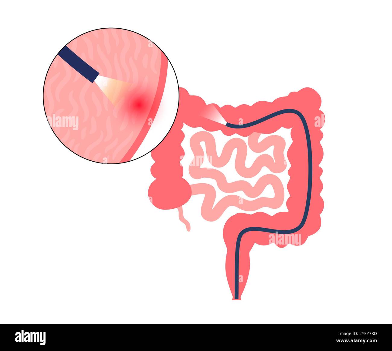 Large intestine endoscopy hi-res stock photography and images - Alamy