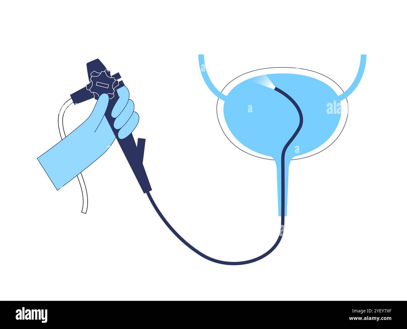 Conceptual illustration of a cystoscopy procedure. This is a procedure ...