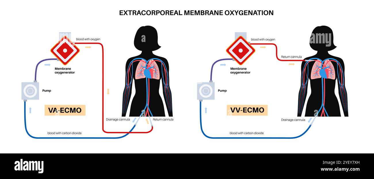 Va ecmo hi-res stock photography and images - Alamy