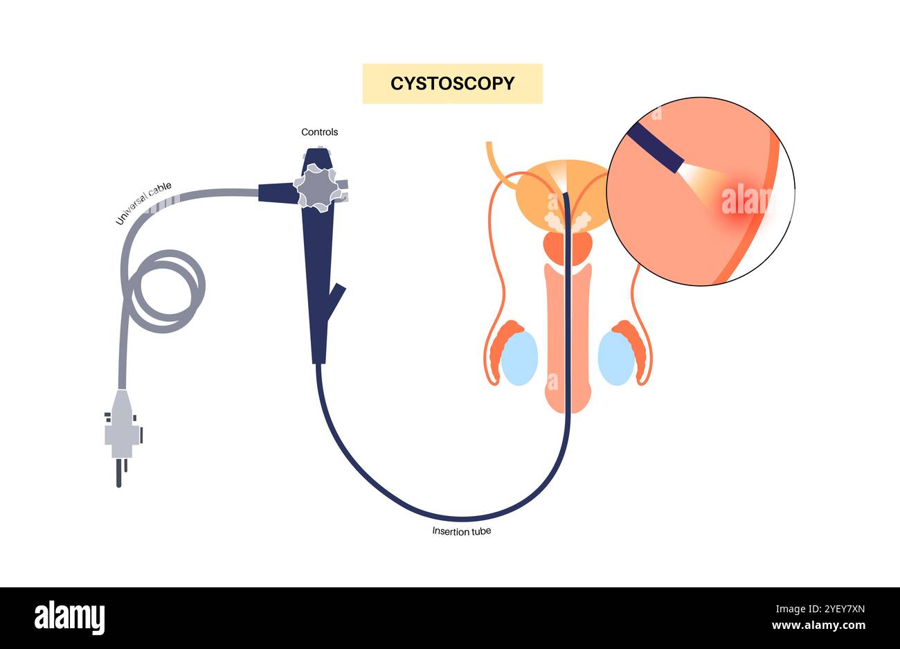 Conceptual illustration of a cystoscopy procedure. This is a procedure used to diagnose, monitor ...