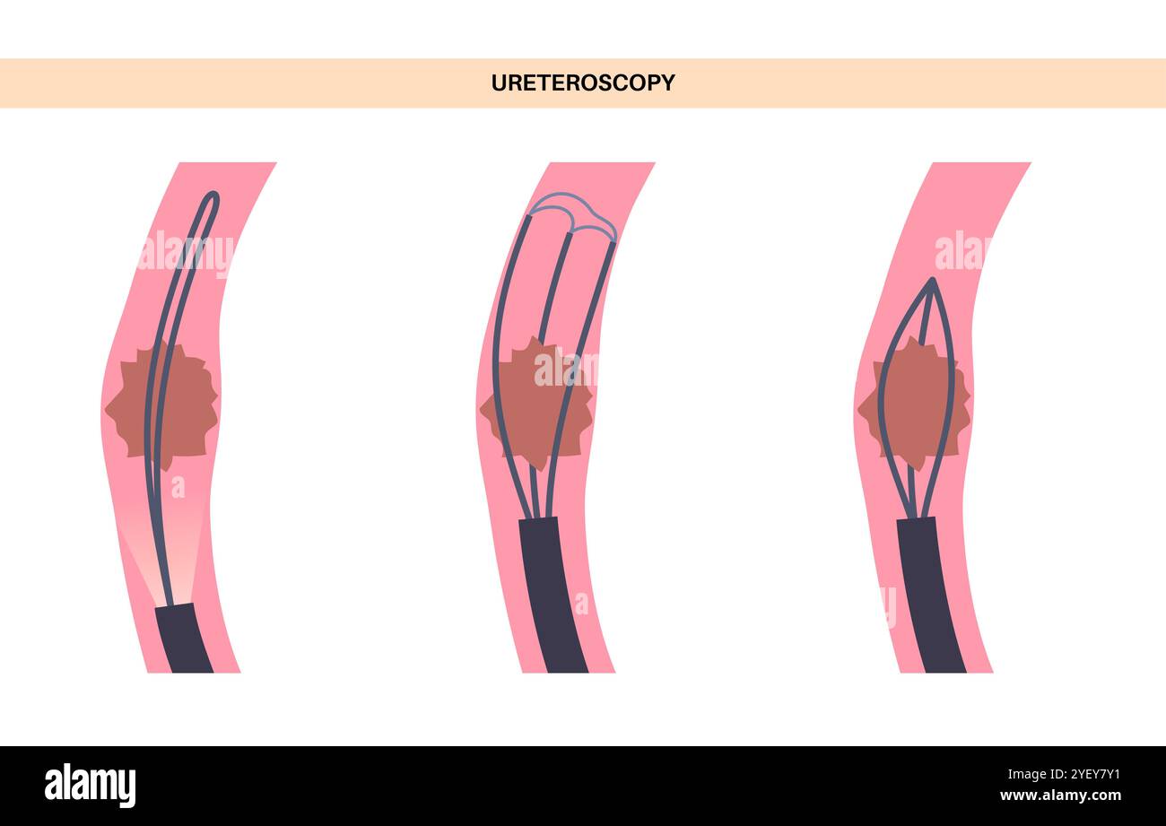 Conceptual illustration of a ureteroscopy procedure. This is a ...