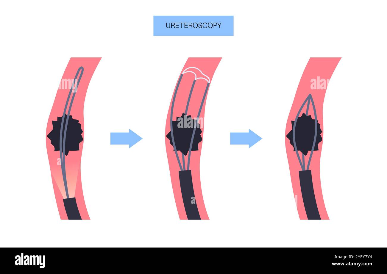 Conceptual illustration of a ureteroscopy procedure. This is a ...