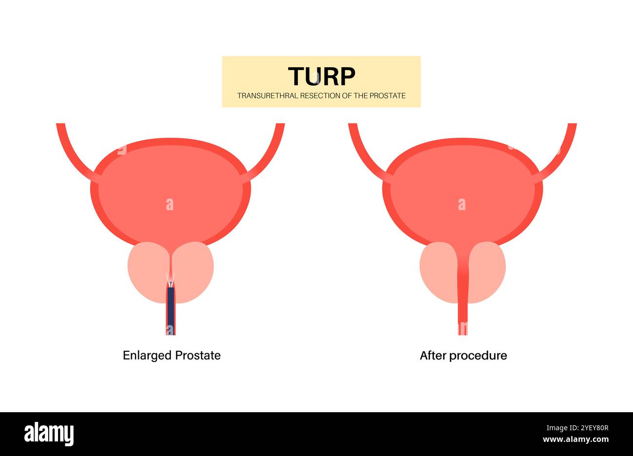 Conceptual Illustration Of A Transurethral Resection Of The Prostate Conceptual Illustration Of A Transurethral Resection Of The Prostate