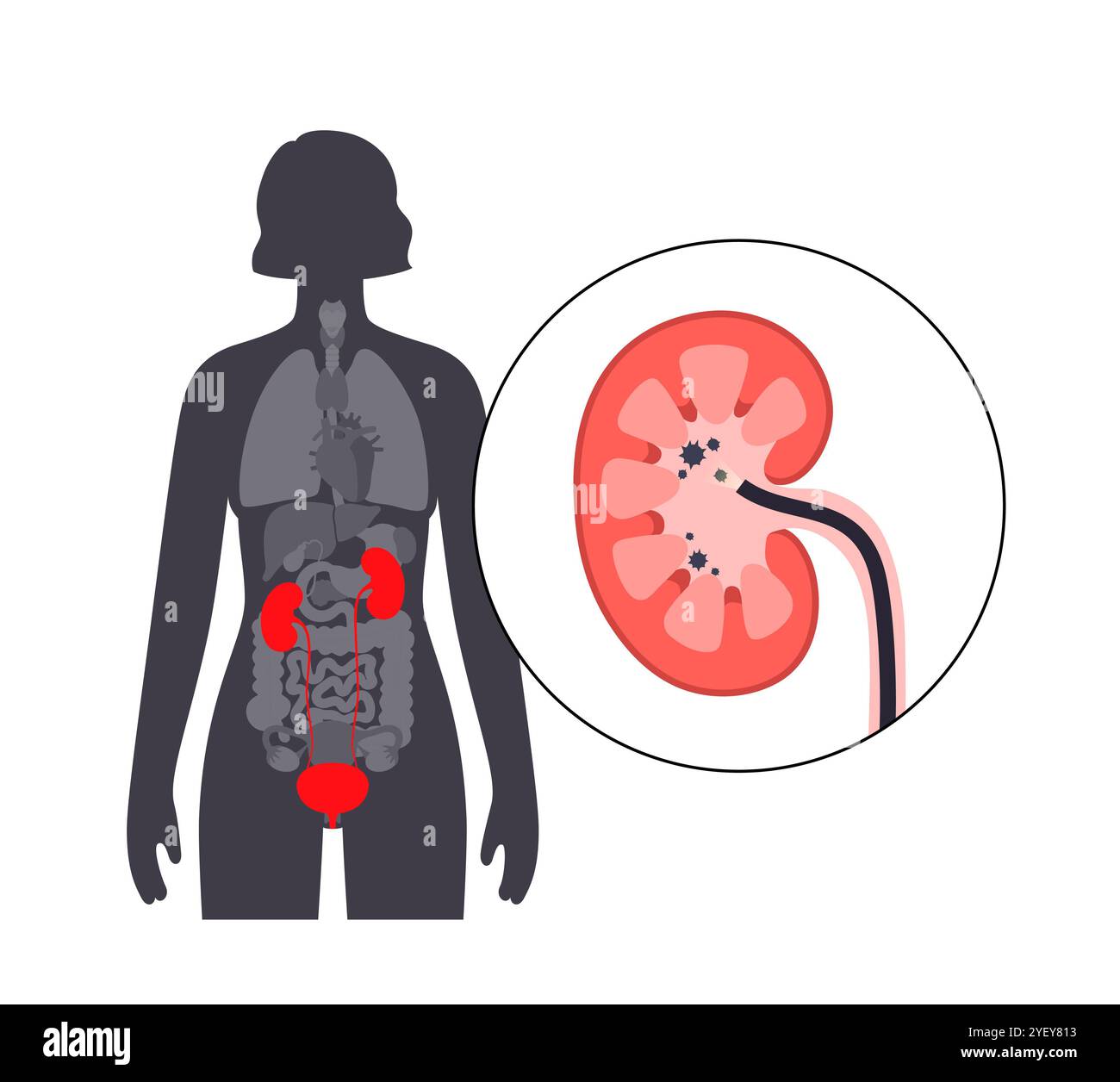 Conceptual illustration of a ureteroscopy procedure. This is a ...