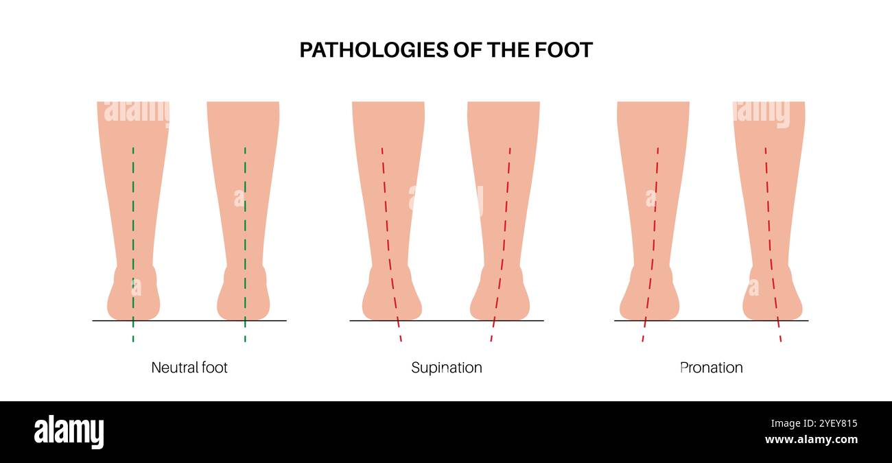 Conceptual illustration of foot pathologies including neutral ...