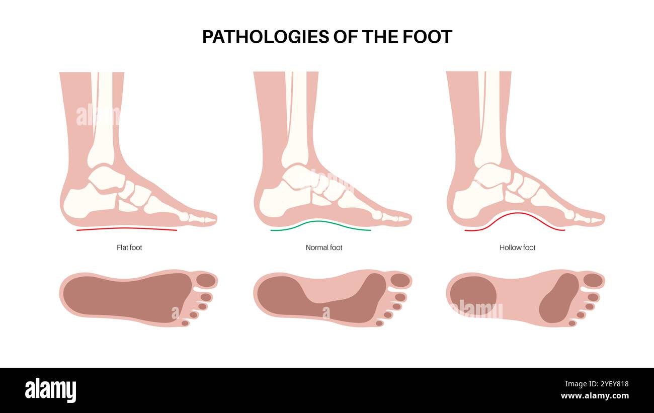 Conceptual illustration of foot pathologies including flat, normal and ...