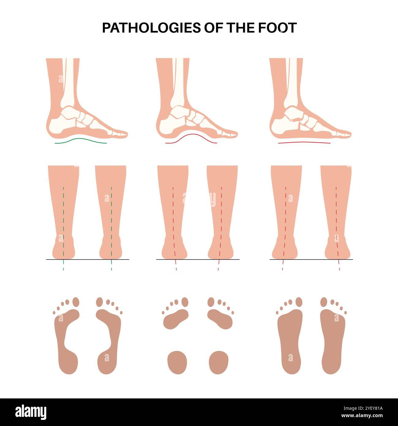 Conceptual illustration of foot pathologies including flat, normal and ...