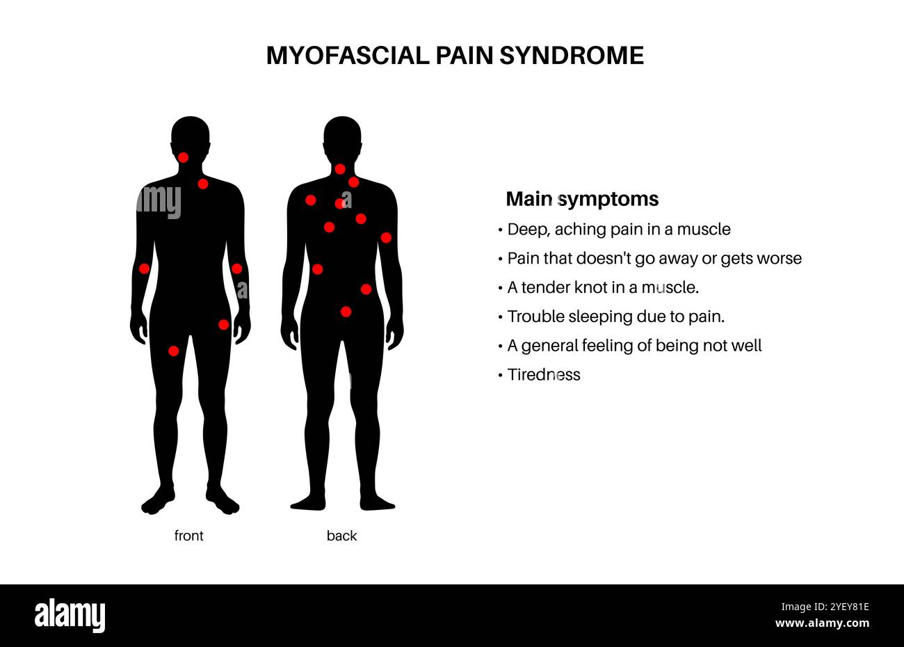 Conceptual illustration of myofascial pain syndrome. Myofascial pain ...