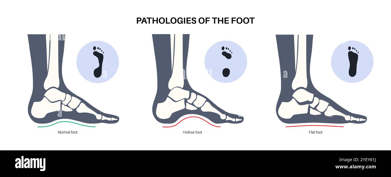 Conceptual illustration of foot pathologies including flat, normal and ...