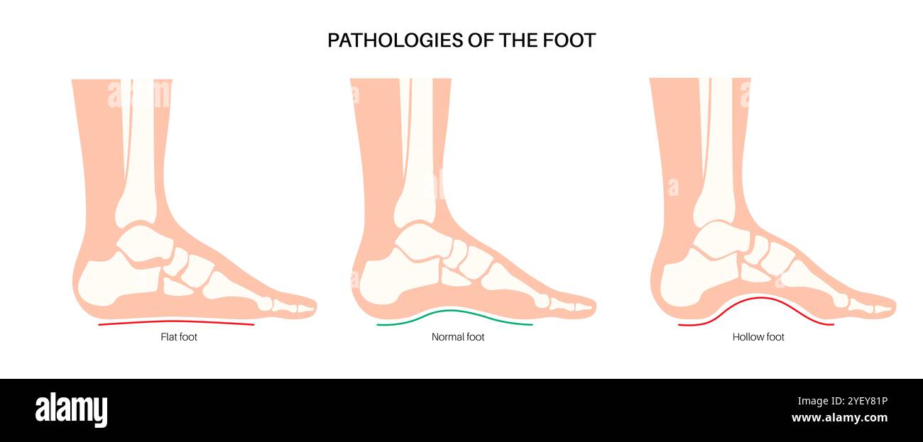 Conceptual illustration of foot pathologies including flat, normal and ...