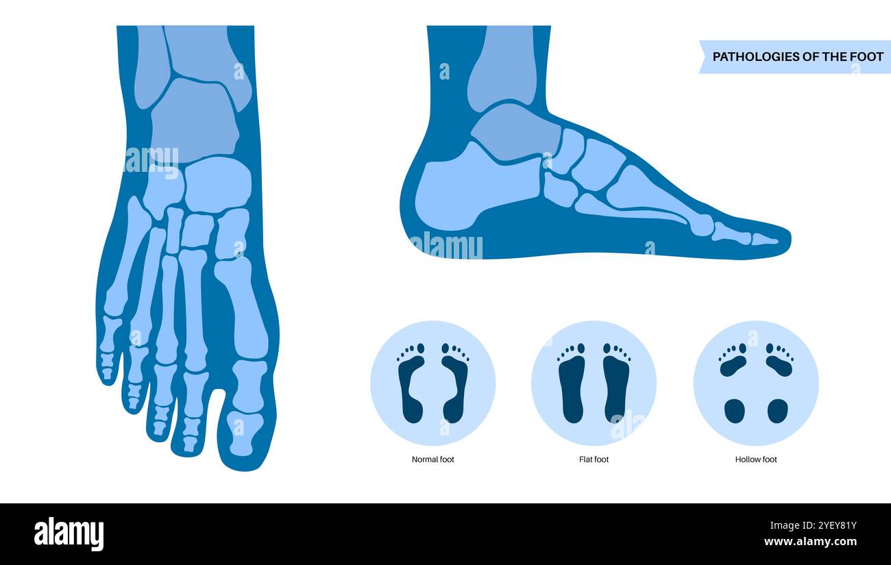 Conceptual illustration of foot pathologies including flat, normal and ...