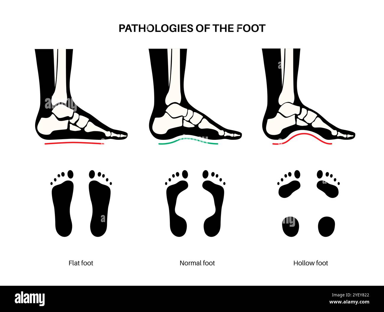 Conceptual illustration of foot pathologies including flat, normal and ...