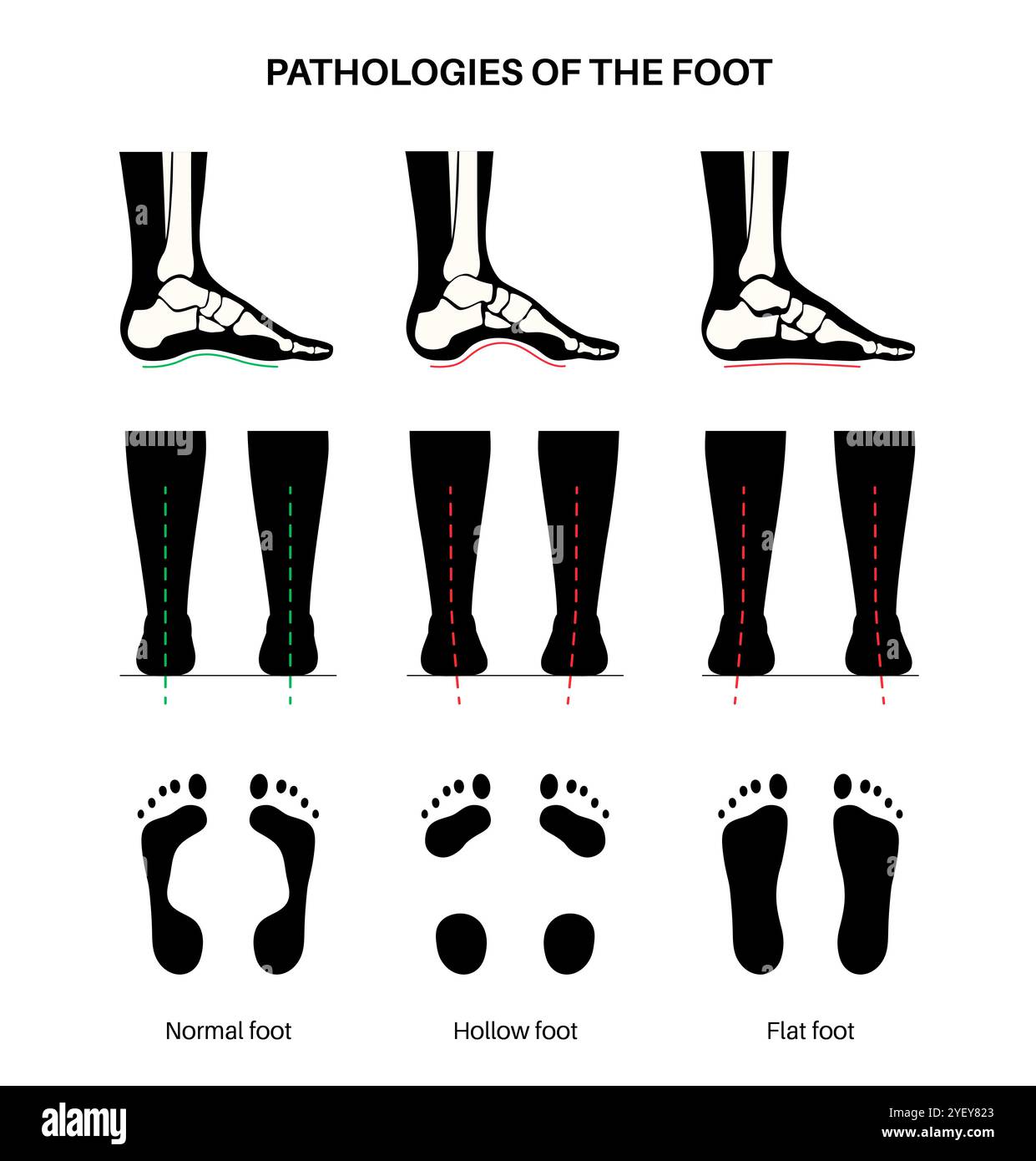 Conceptual illustration of foot pathologies including flat, normal and ...