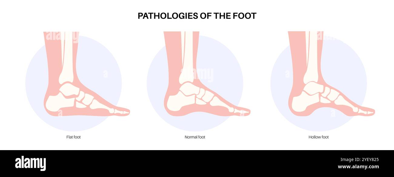 Conceptual illustration of foot pathologies including flat, normal and ...