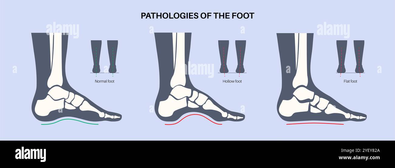 Conceptual illustration of foot pathologies including flat, normal and ...