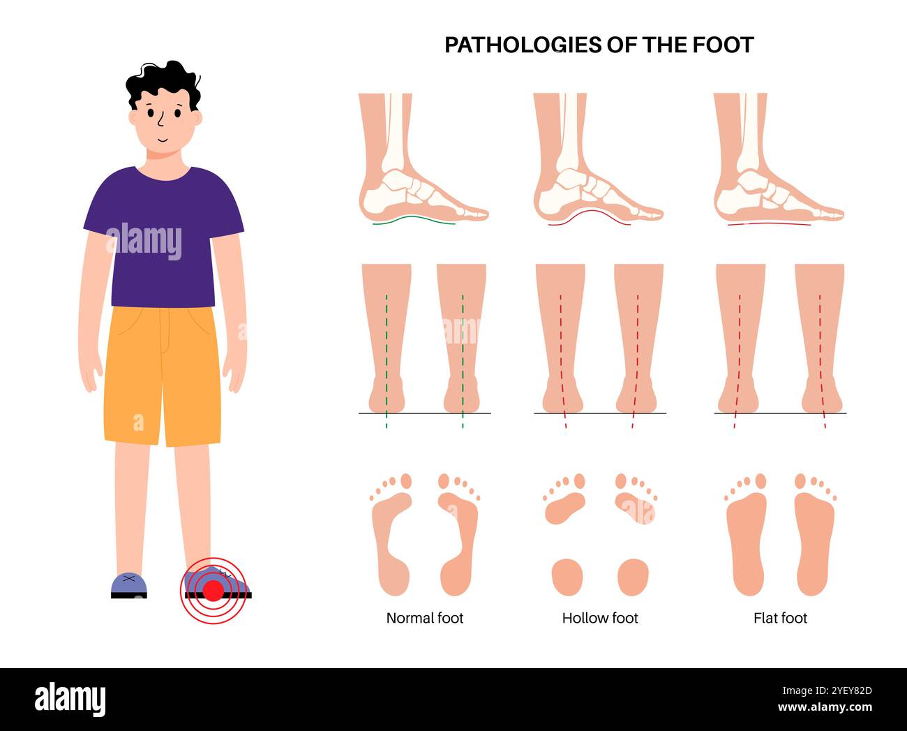 Conceptual illustration of foot pathologies including flat, normal and ...