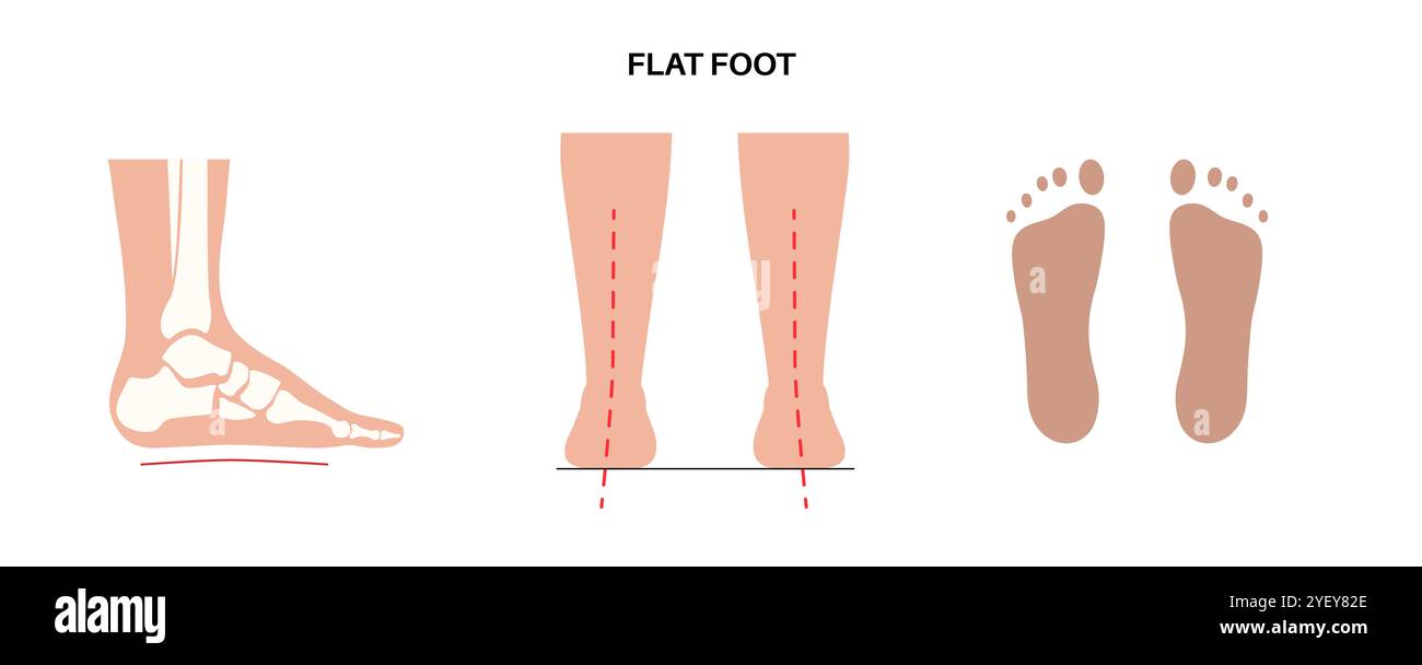 Conceptual illustration of the fallen arches or flat feet condition. A ...