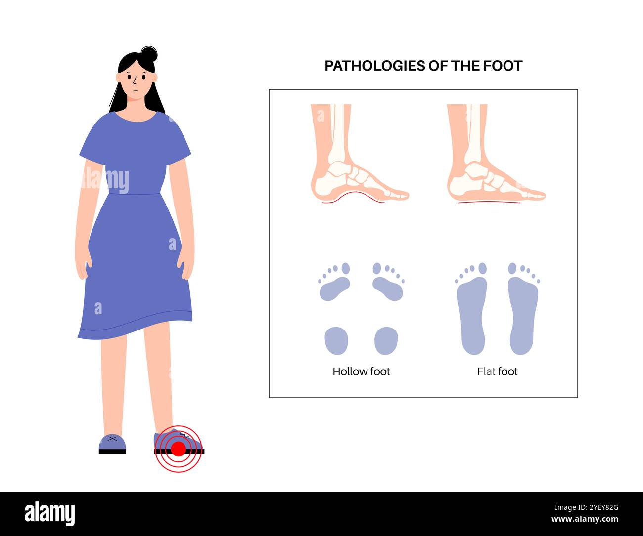 Conceptual illustration of foot pathologies including flat and hollow ...