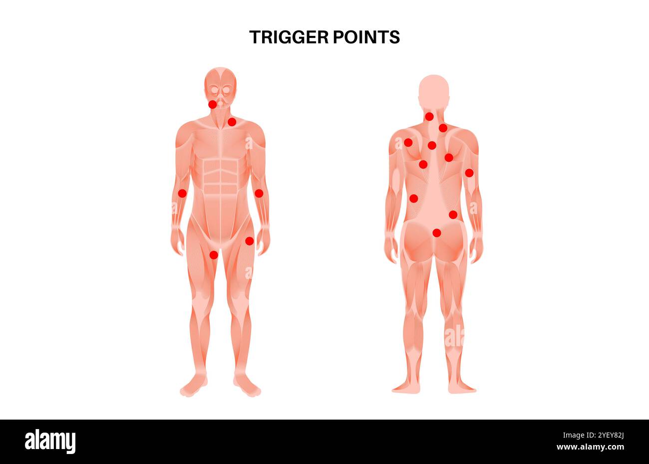 Conceptual illustration of myofascial trigger points. A myofascial trigger point (MTrP), also ...