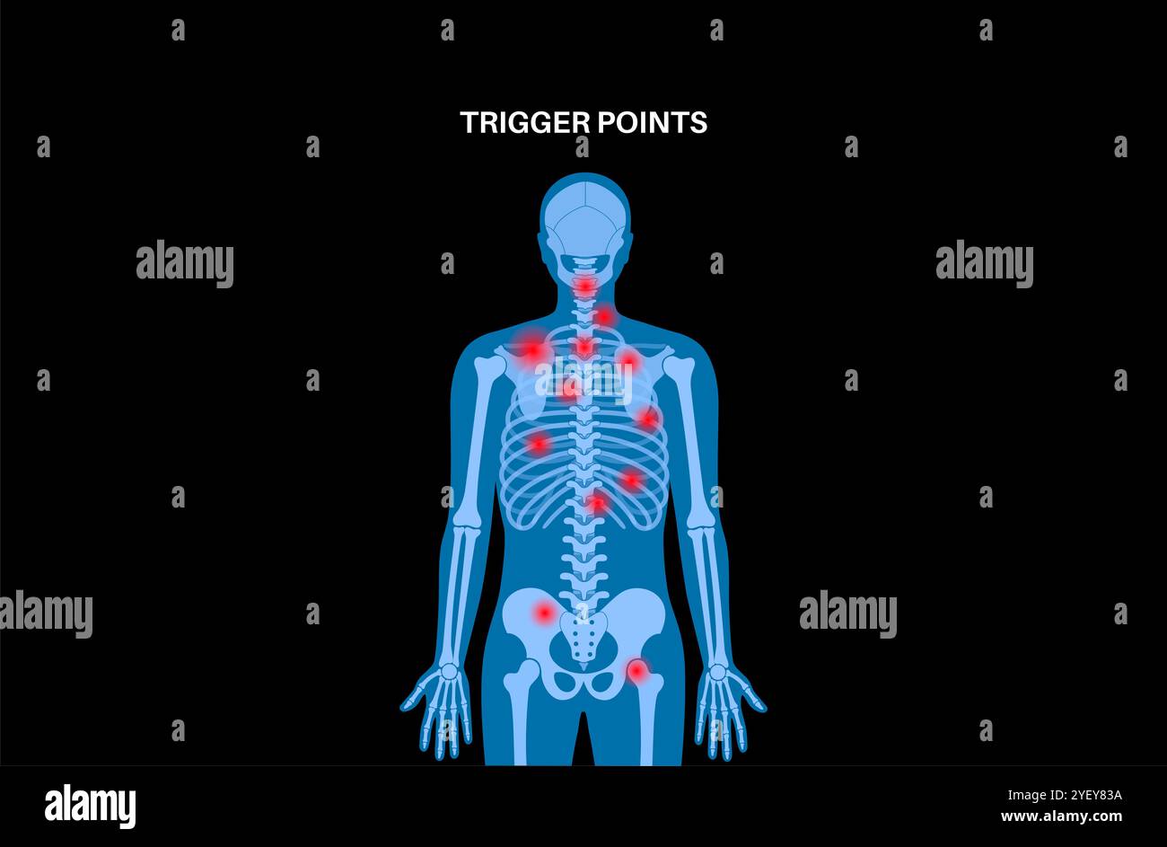 Conceptual illustration of myofascial trigger points. A myofascial ...