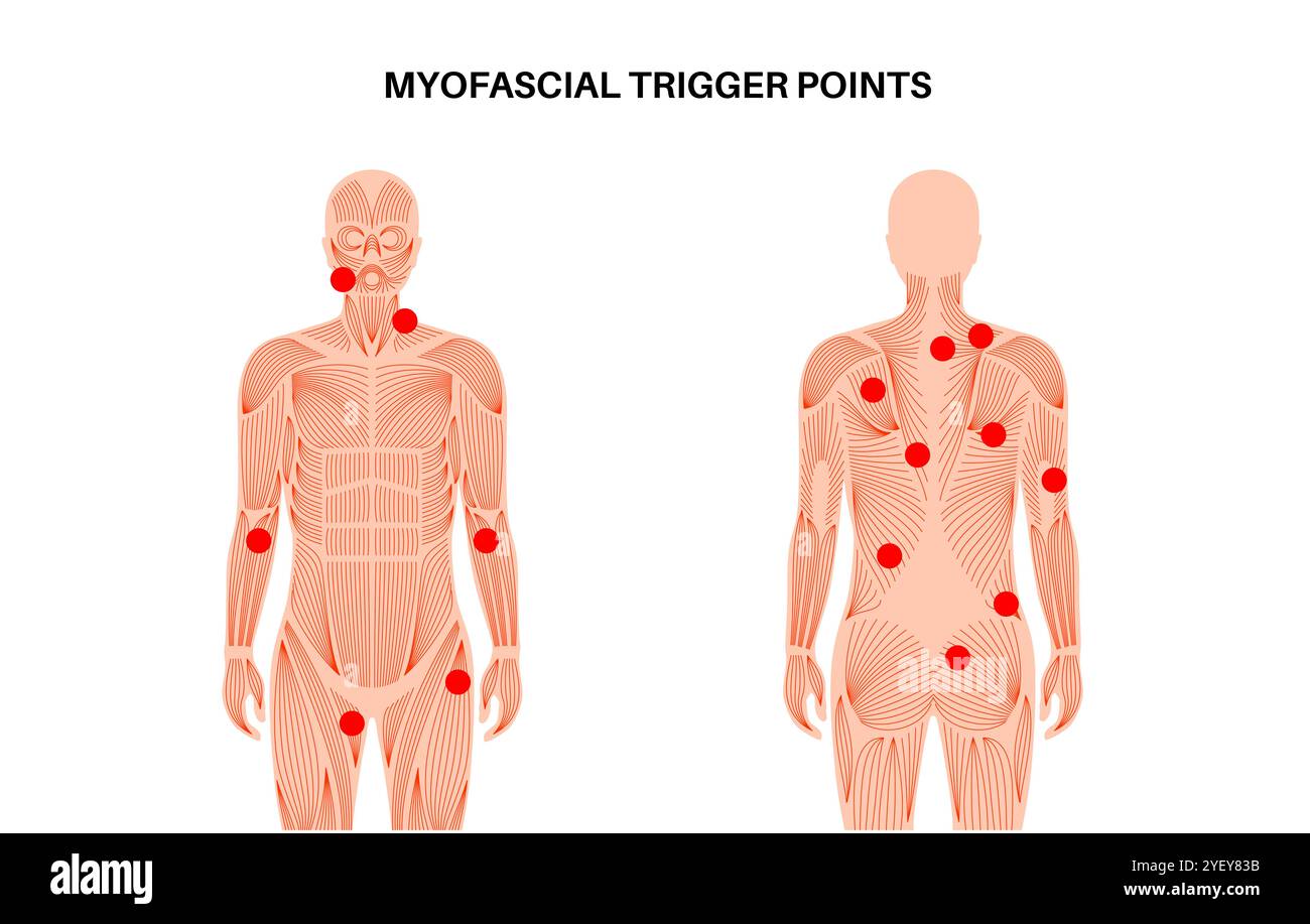 Conceptual illustration of myofascial trigger points. A myofascial trigger point (MTrP), also ...