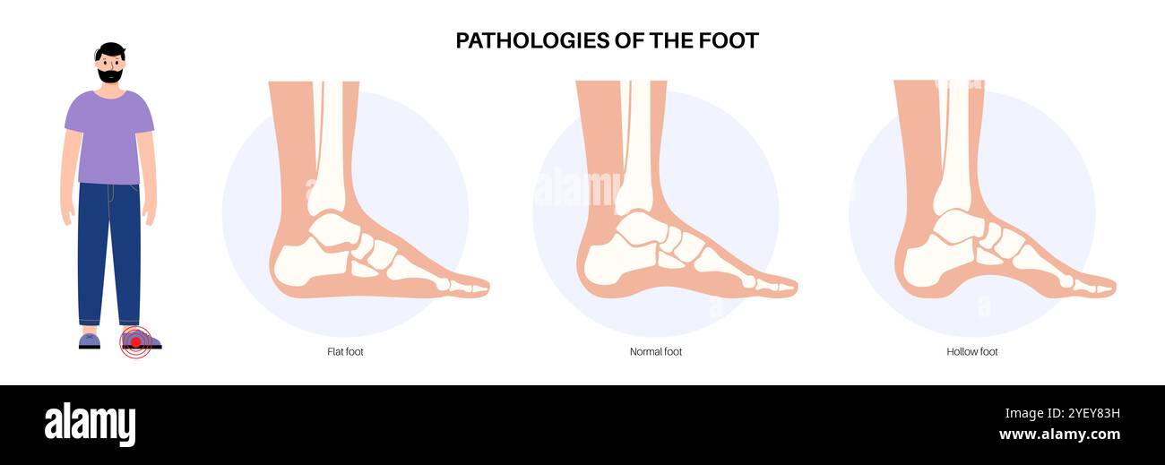 Conceptual illustration of foot pathologies including flat, normal and ...