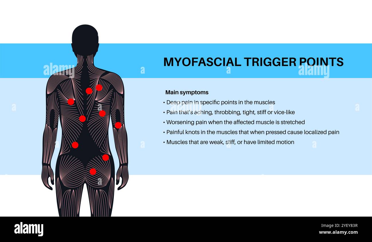 Myofascial trigger points hi-res stock photography and images - Alamy