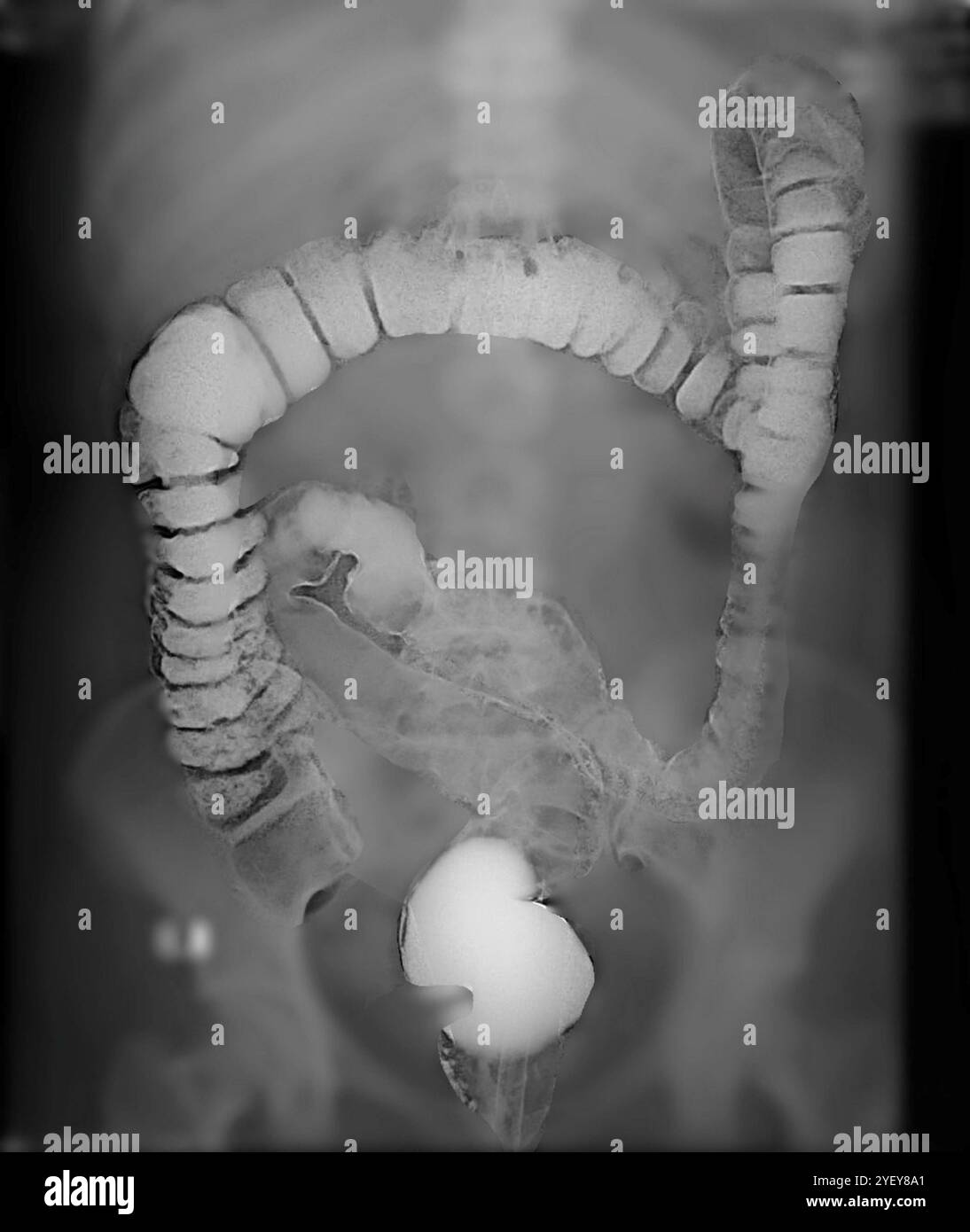 Frontal X-ray of a healthy colon (large intestine). The colon is the ...