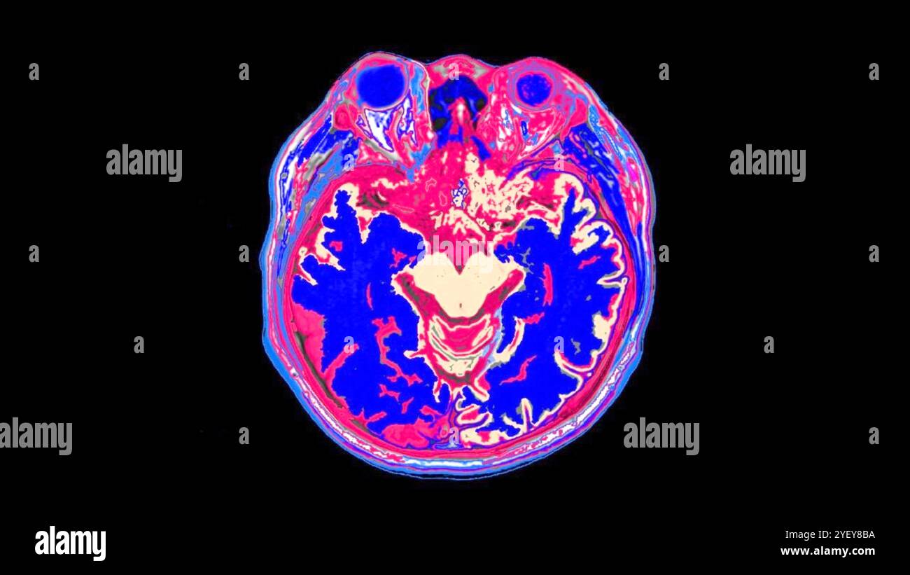 Coloured magnetic resonance imaging (MRI) scan of a healthy human brain Stock Photo - Alamy