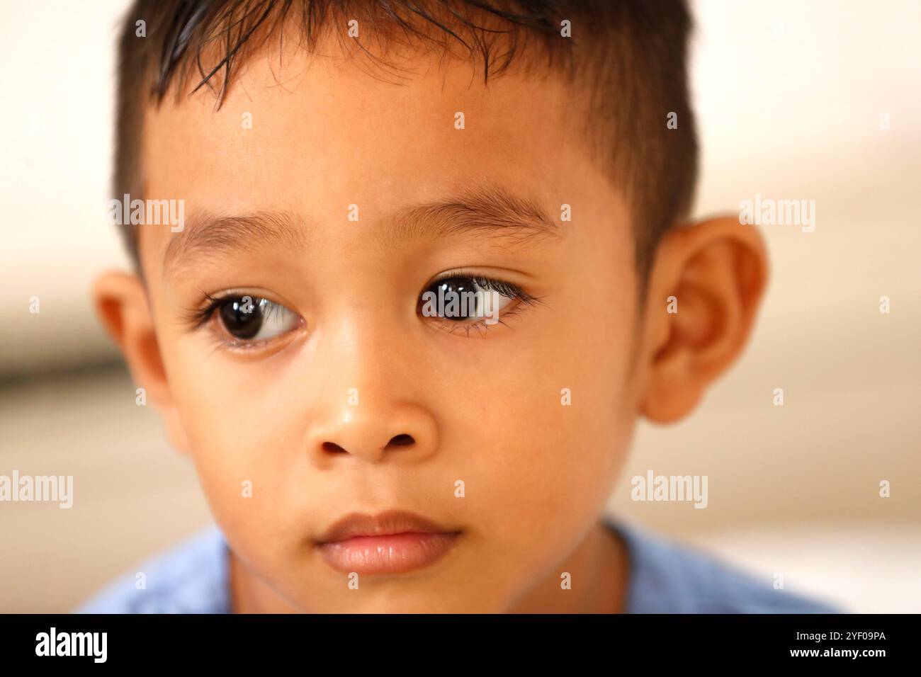 Calmette hospital. Child suffering of congenital heart disease. French ...