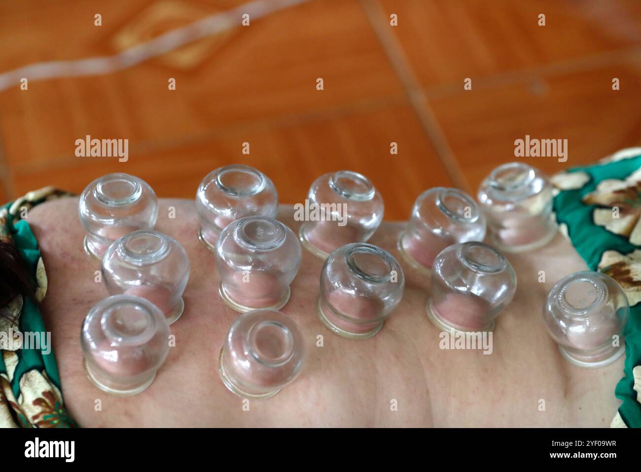 Woman receiving a cupping therapy. Multiple vacuum cup of medical ...