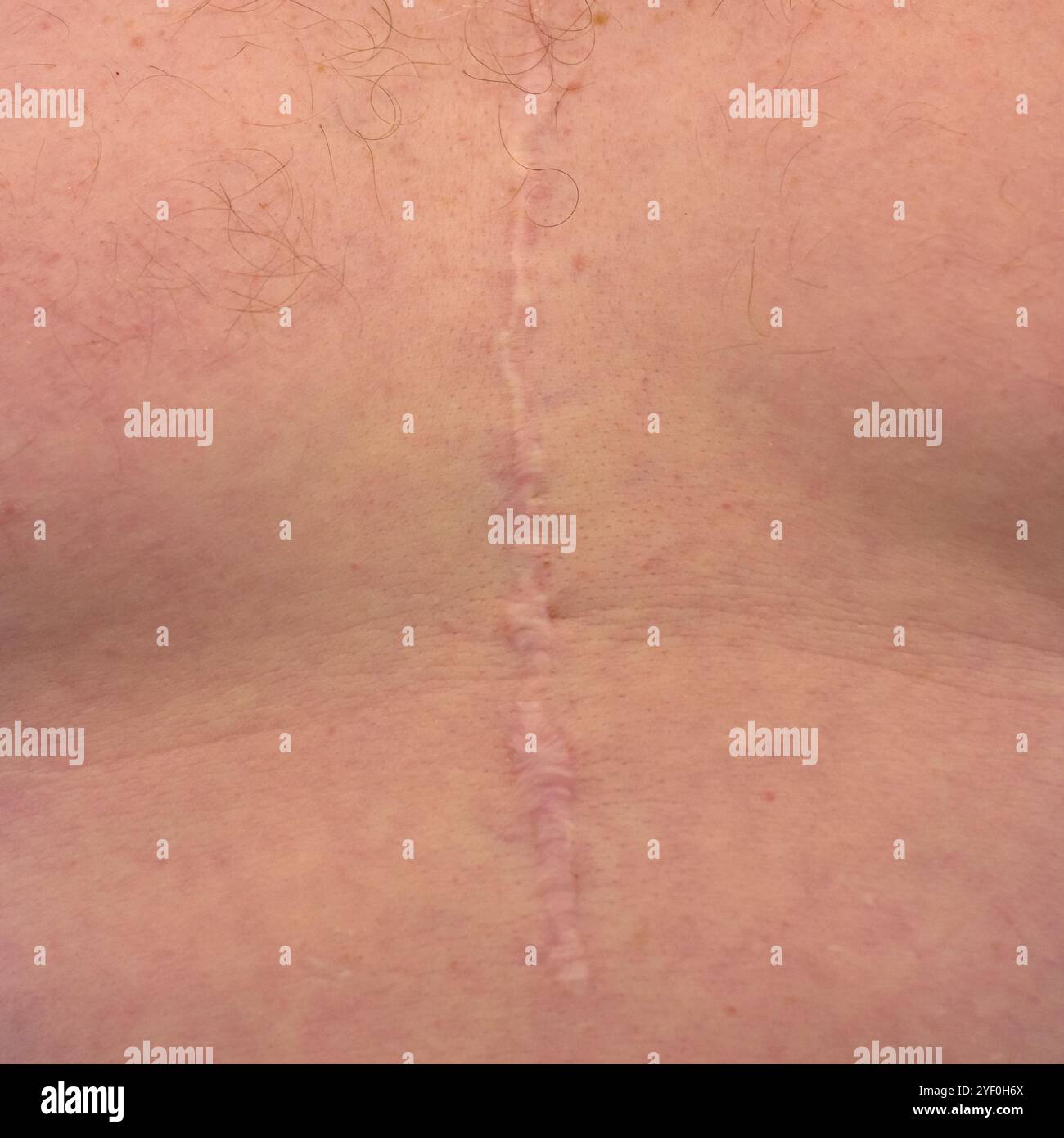 Scar from open heart surgery on white man, where the sternum was cut in ...