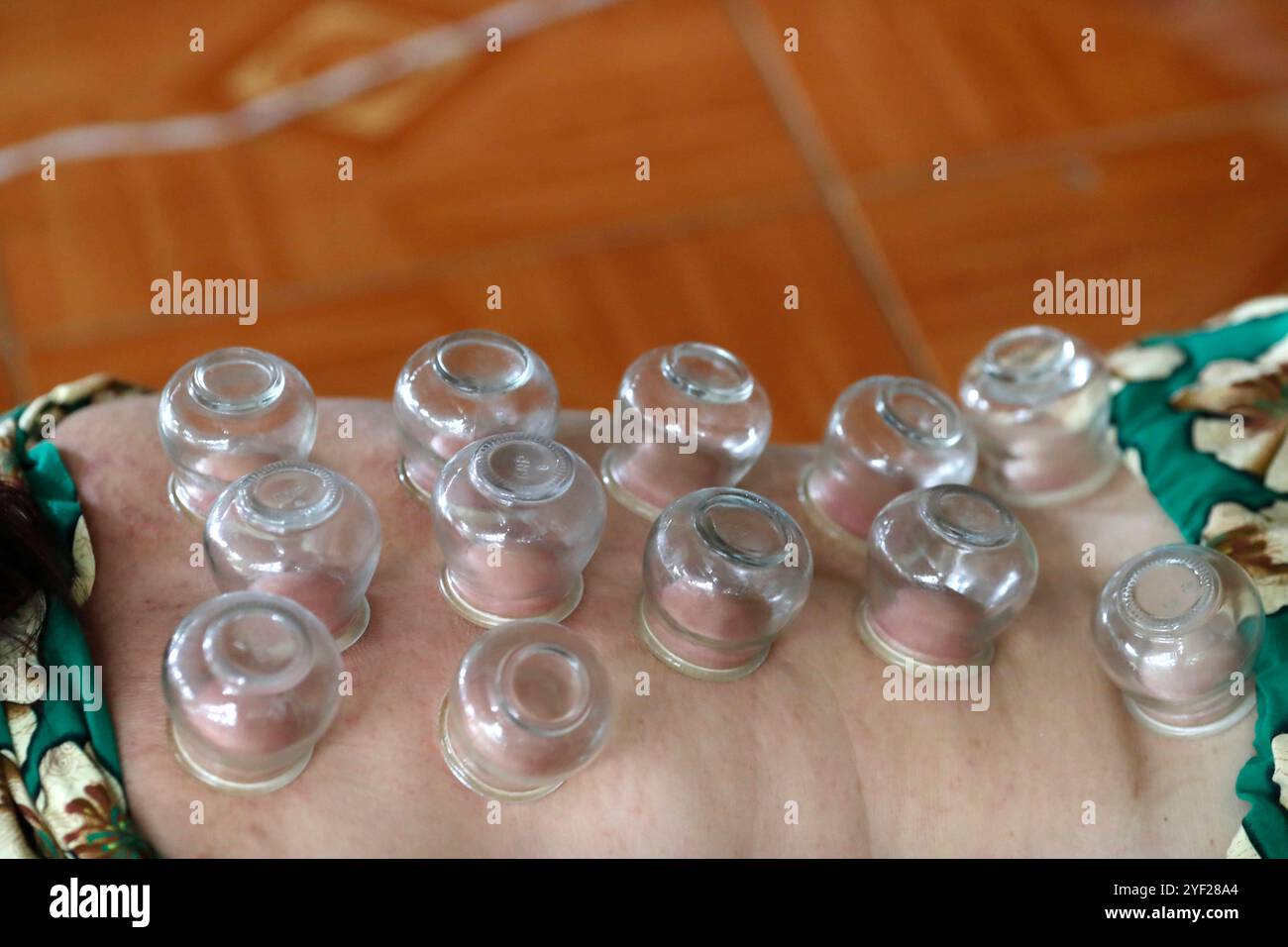 Woman receiving a cupping therapy. Multiple vacuum cup of medical ...