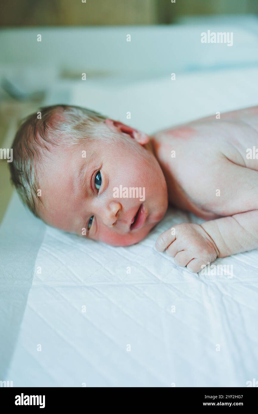 A newborn baby is lying on a diaper with a red rash on his body ...