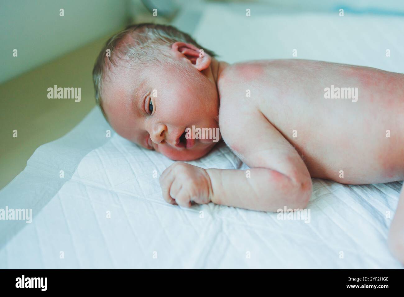 A newborn baby is lying on a diaper with a red rash on his body ...