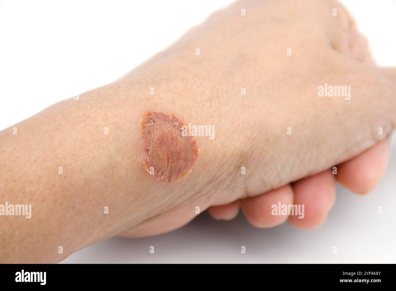 Ring worm skin hi-res stock photography and images - Alamy