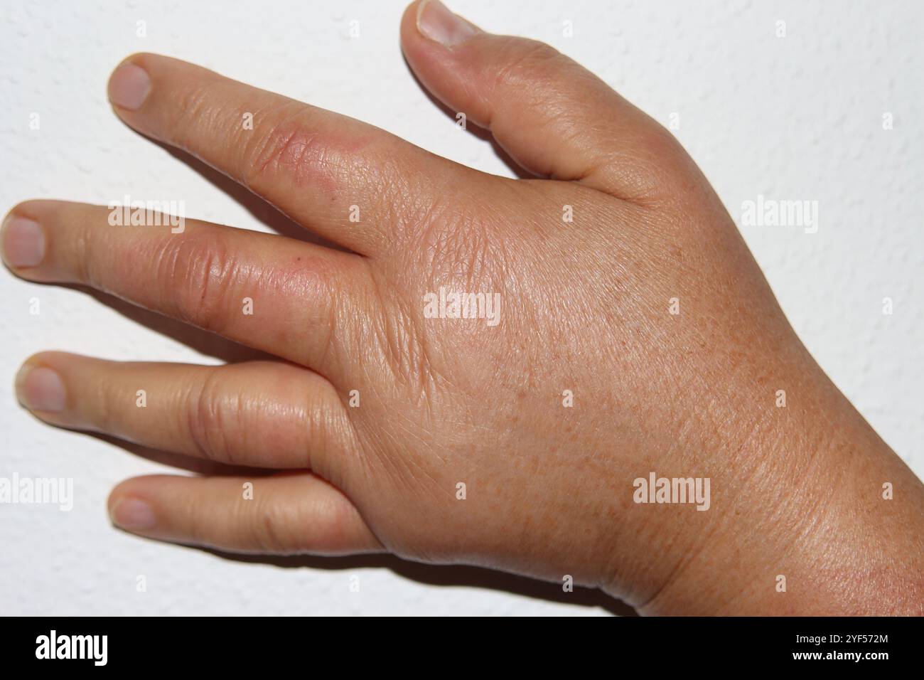 Swollen Hand After Insect Bite Stock Photo - Alamy