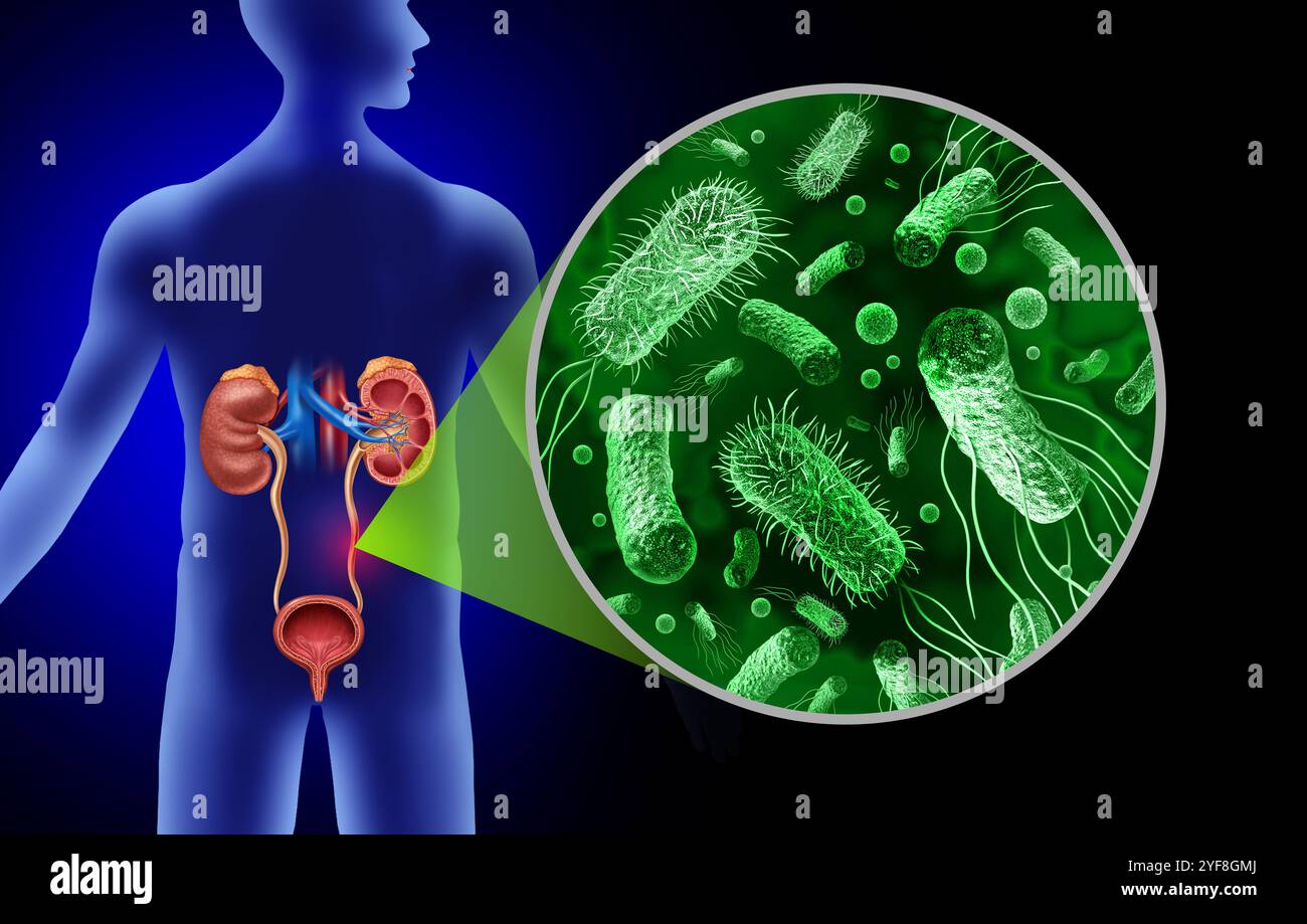 Urinary Tract Infection or UTI anatomy caused by bacteria as E coli ...