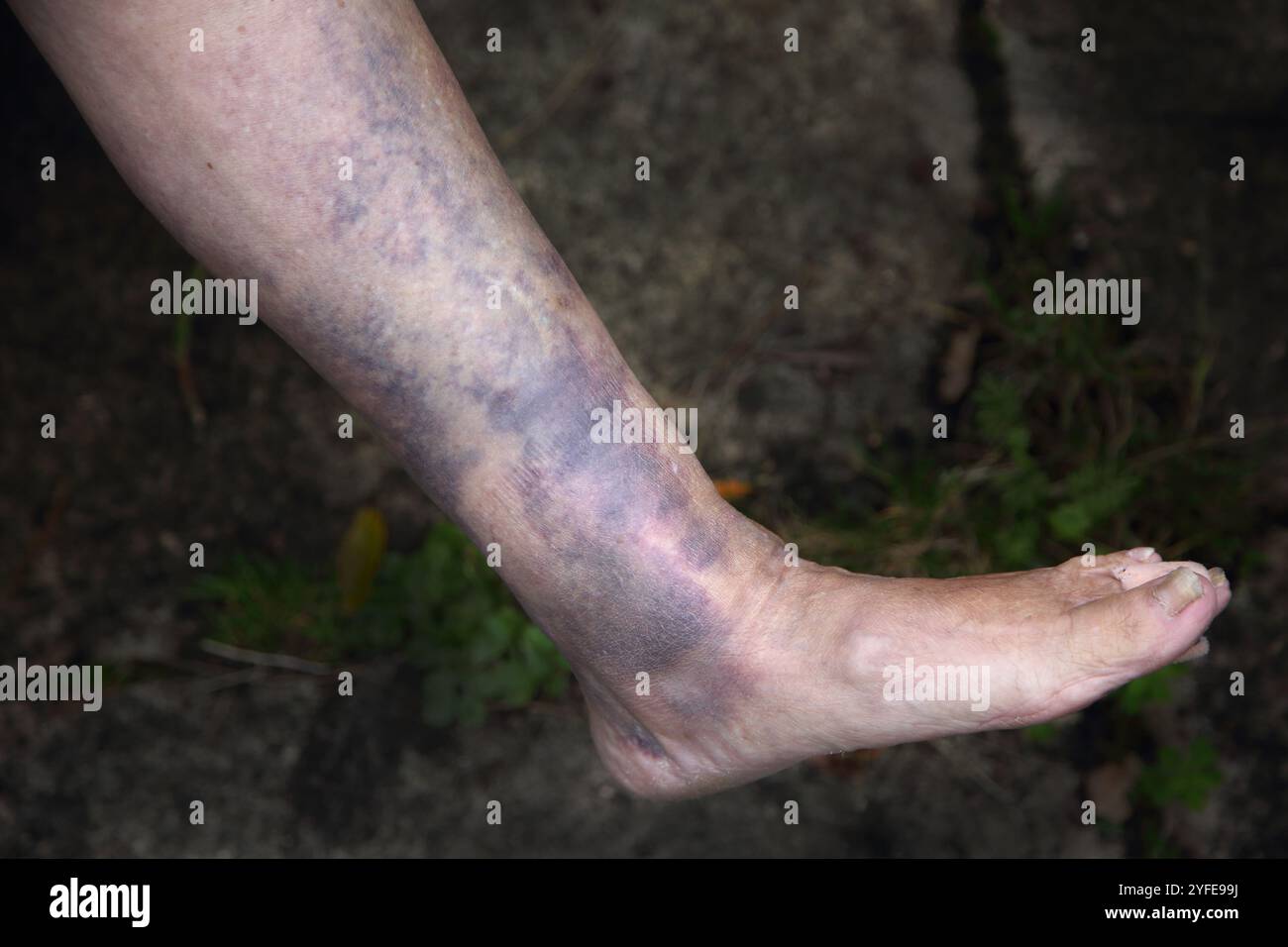 Badly Bruised (Ecchymosis) Leg from a bad Fall Stock Photo - Alamy
