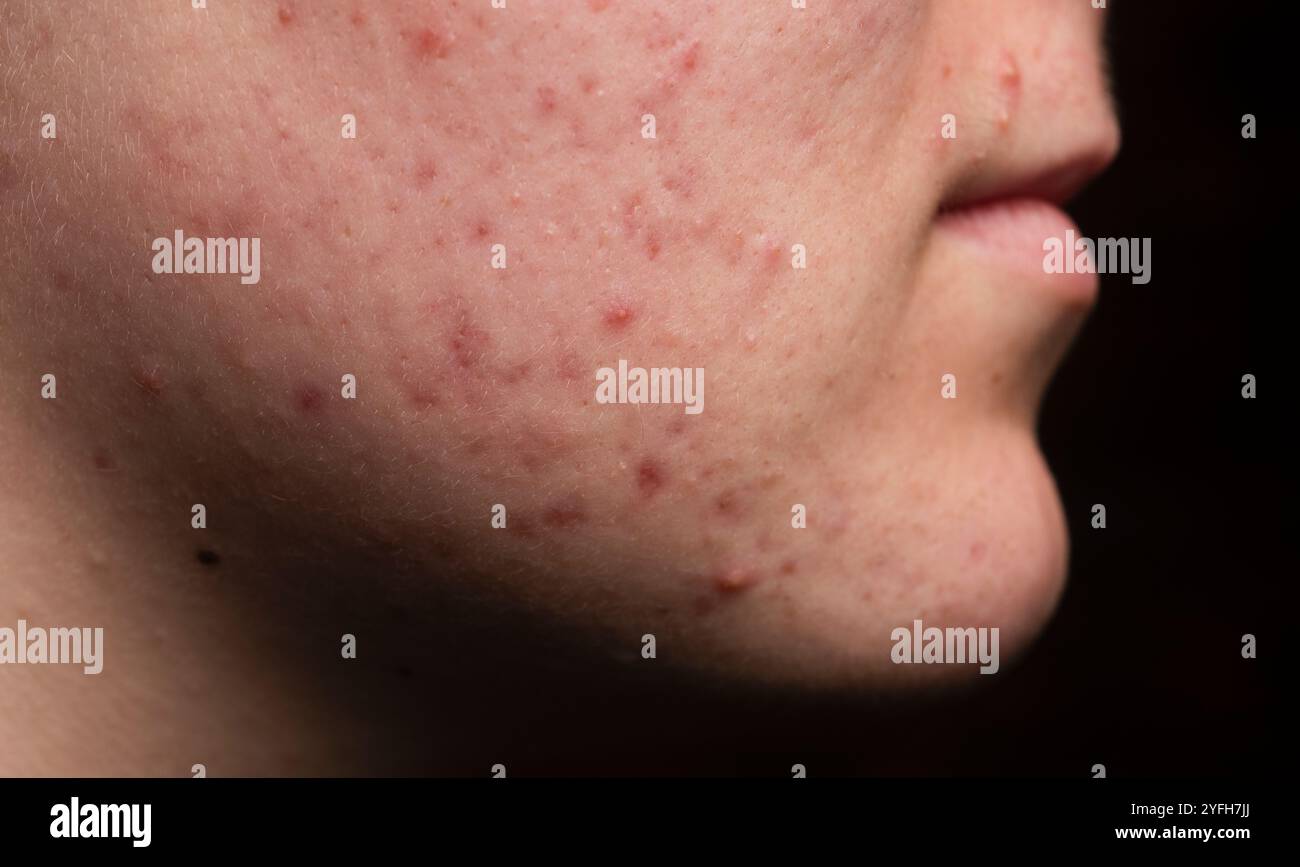 Skin treatment. Acne vulgaris, black spots and pimples. Girl with bad ...