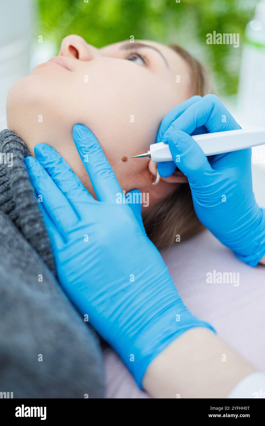 Modern medical equipment for removing neoplasms on the surface of the ...