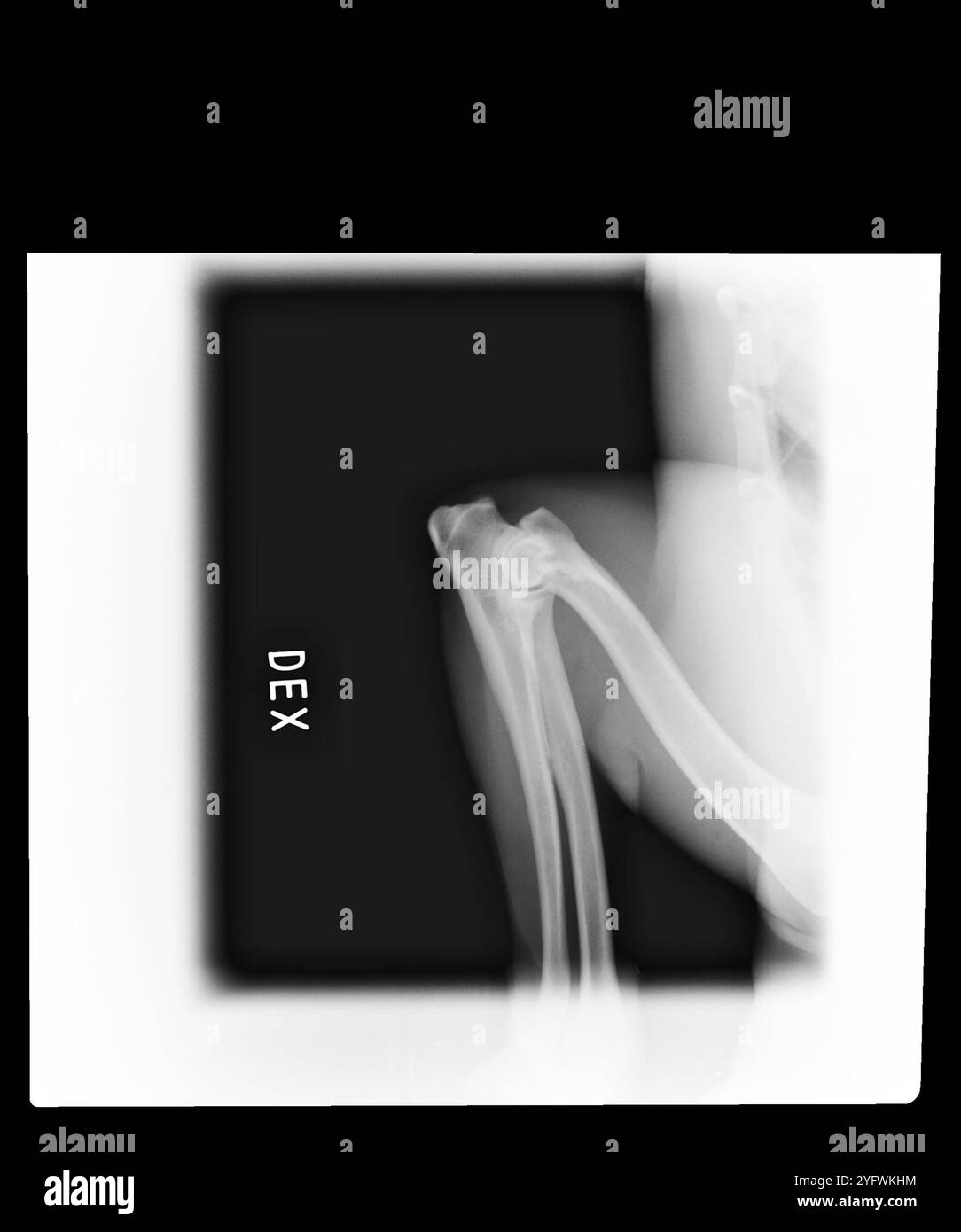 X ray elbow hi-res stock photography and images - Alamy