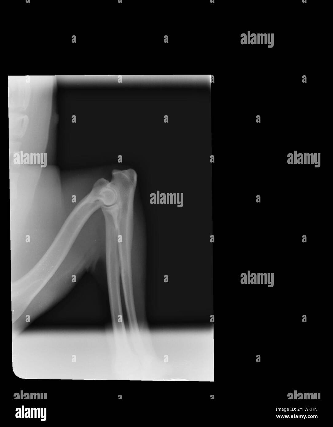 Elbow x ray hi-res stock photography and images - Alamy