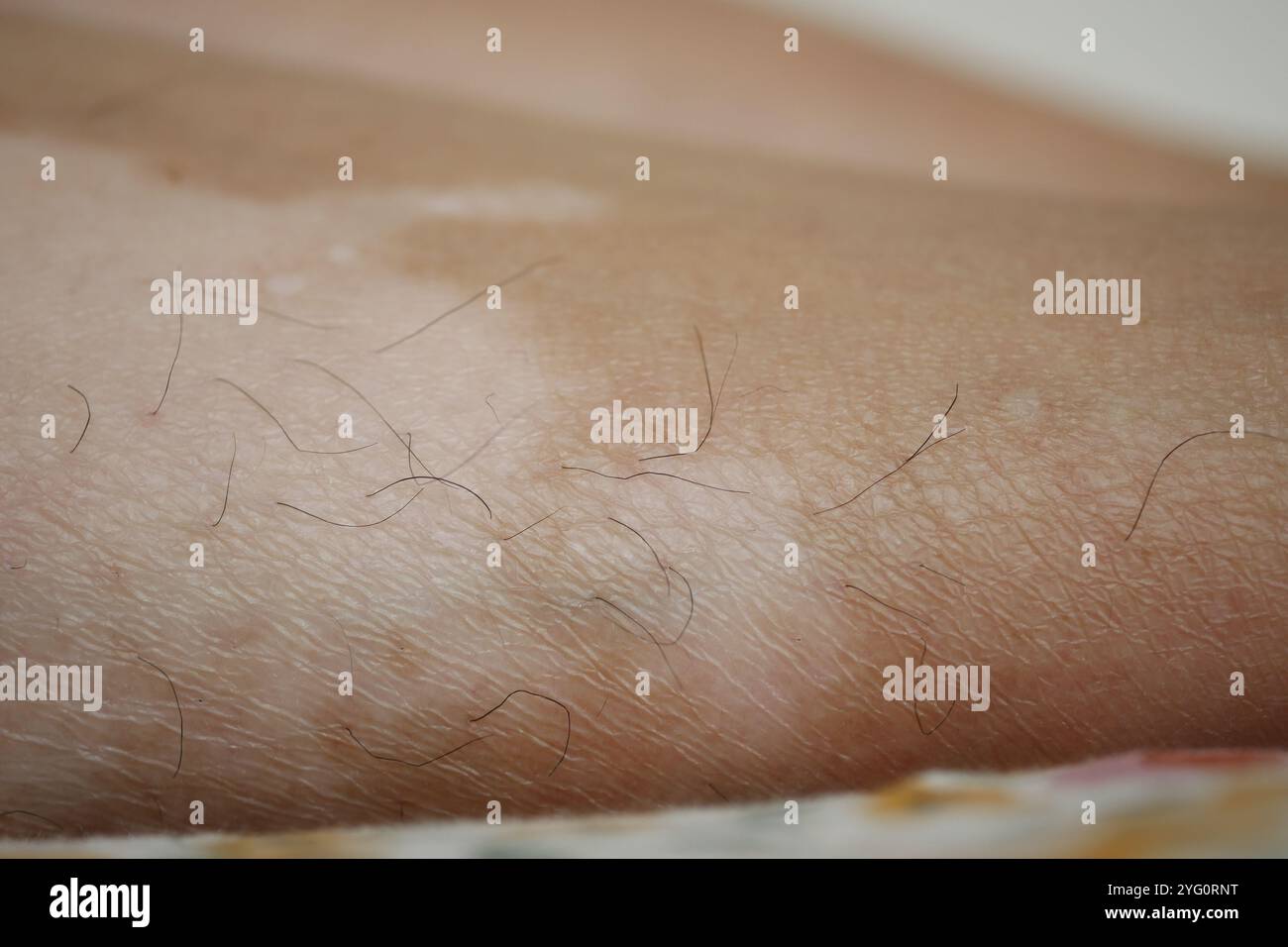 feet with vitiligo skin condition Stock Photo - Alamy
